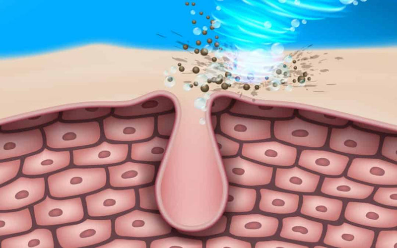 Cystic Acne: How to Treat and Prevent It