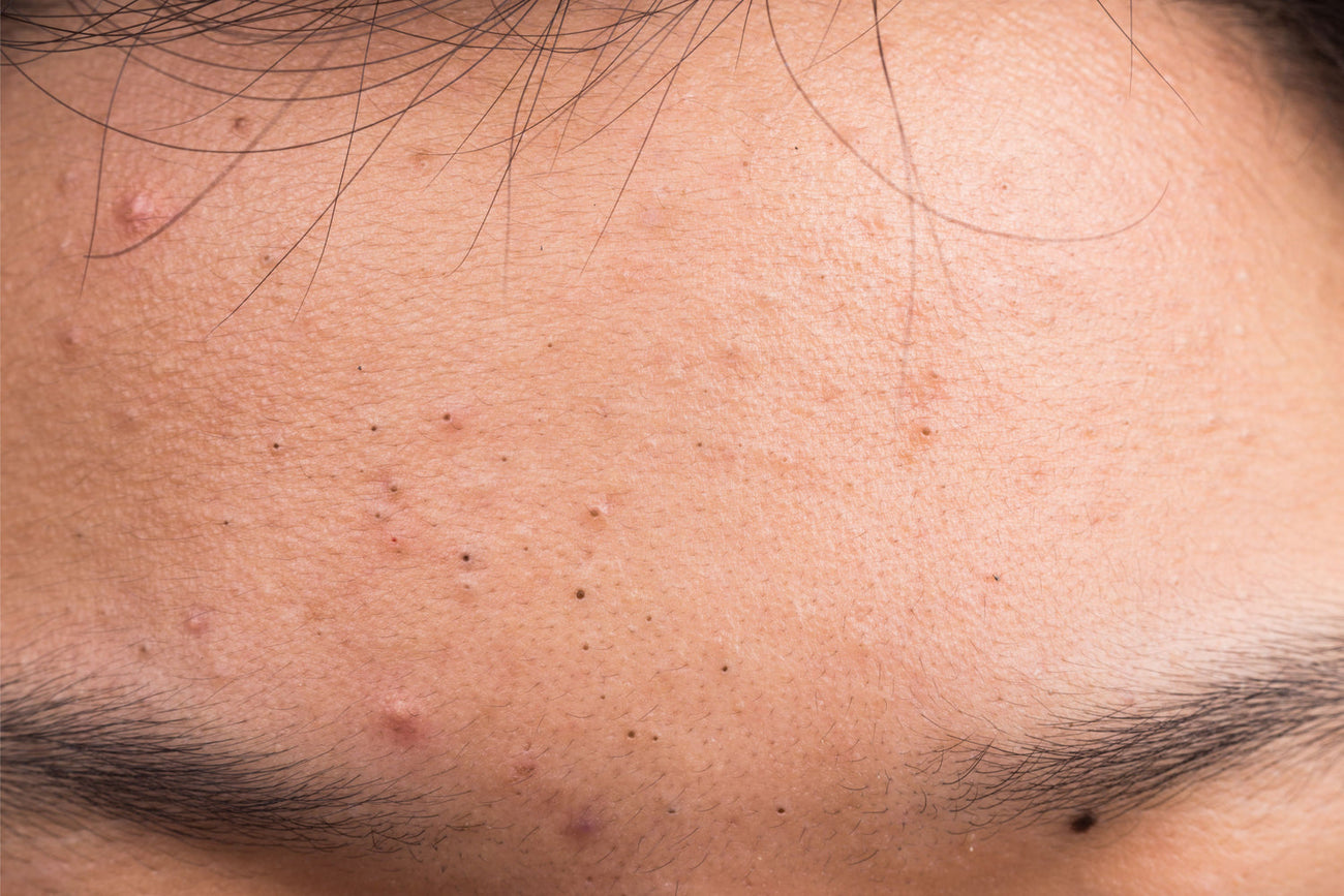 Closed comedones: Causes and How to Get Rid of Closed Comedones